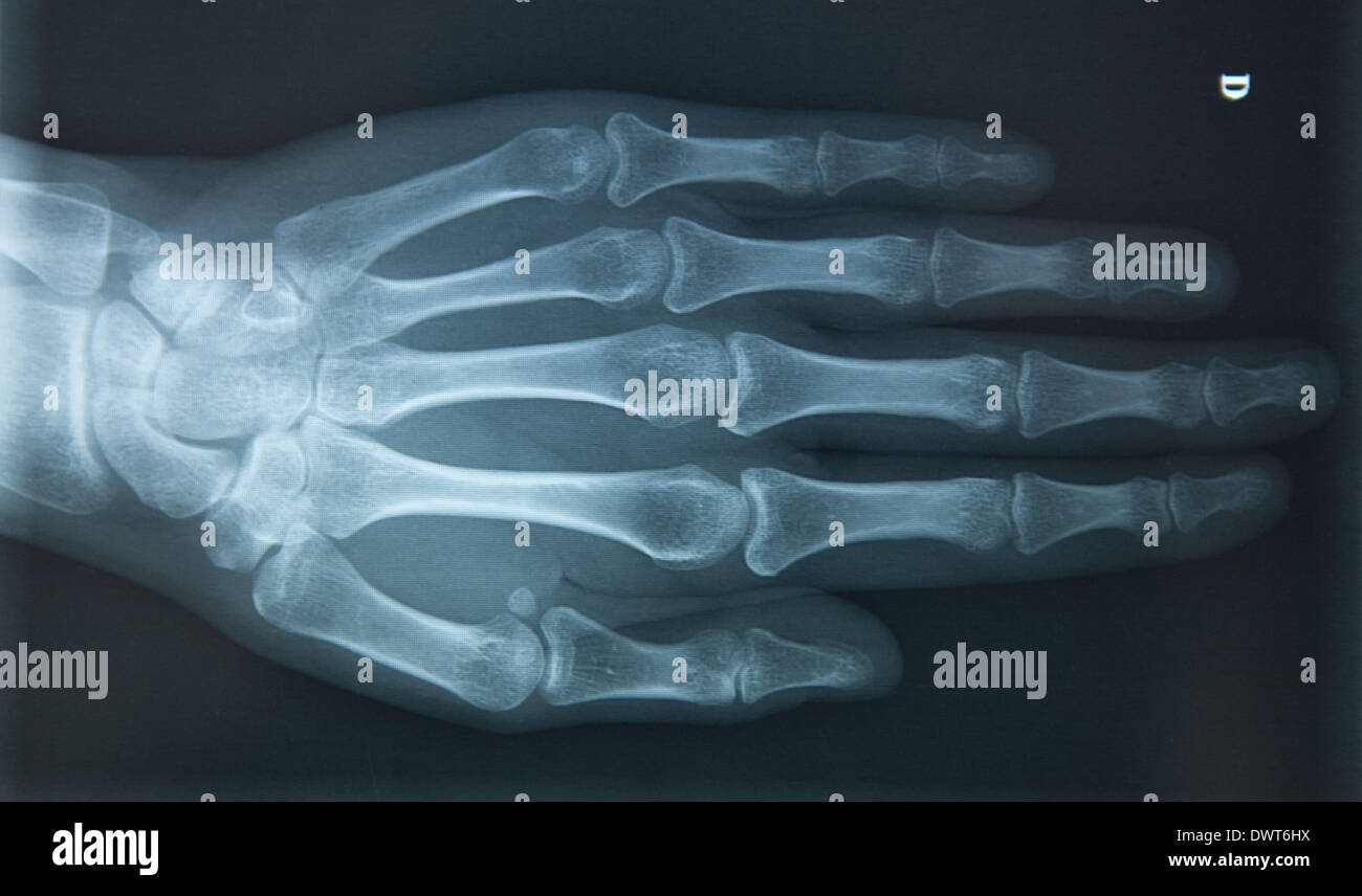 Hand x ray Stock Photo - Alamy