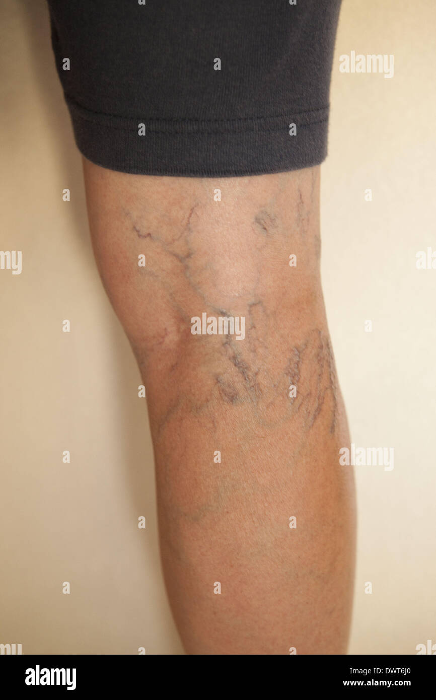 Varicose vein leg Stock Photo - Alamy