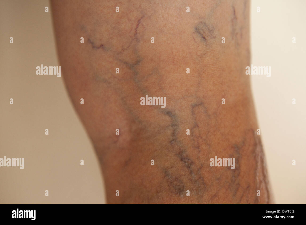 Varicose vein leg Stock Photo - Alamy
