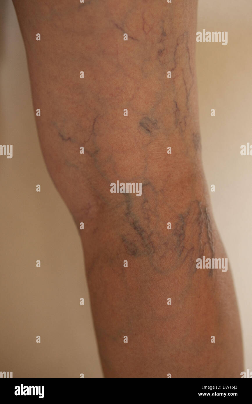 Varicose vein leg Stock Photo - Alamy
