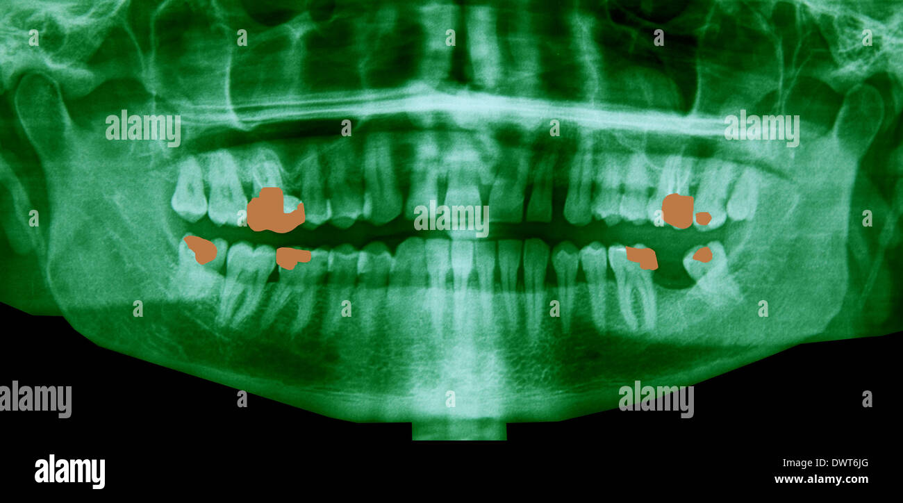 Dental x ray amalgam hi-res stock photography and images - Alamy