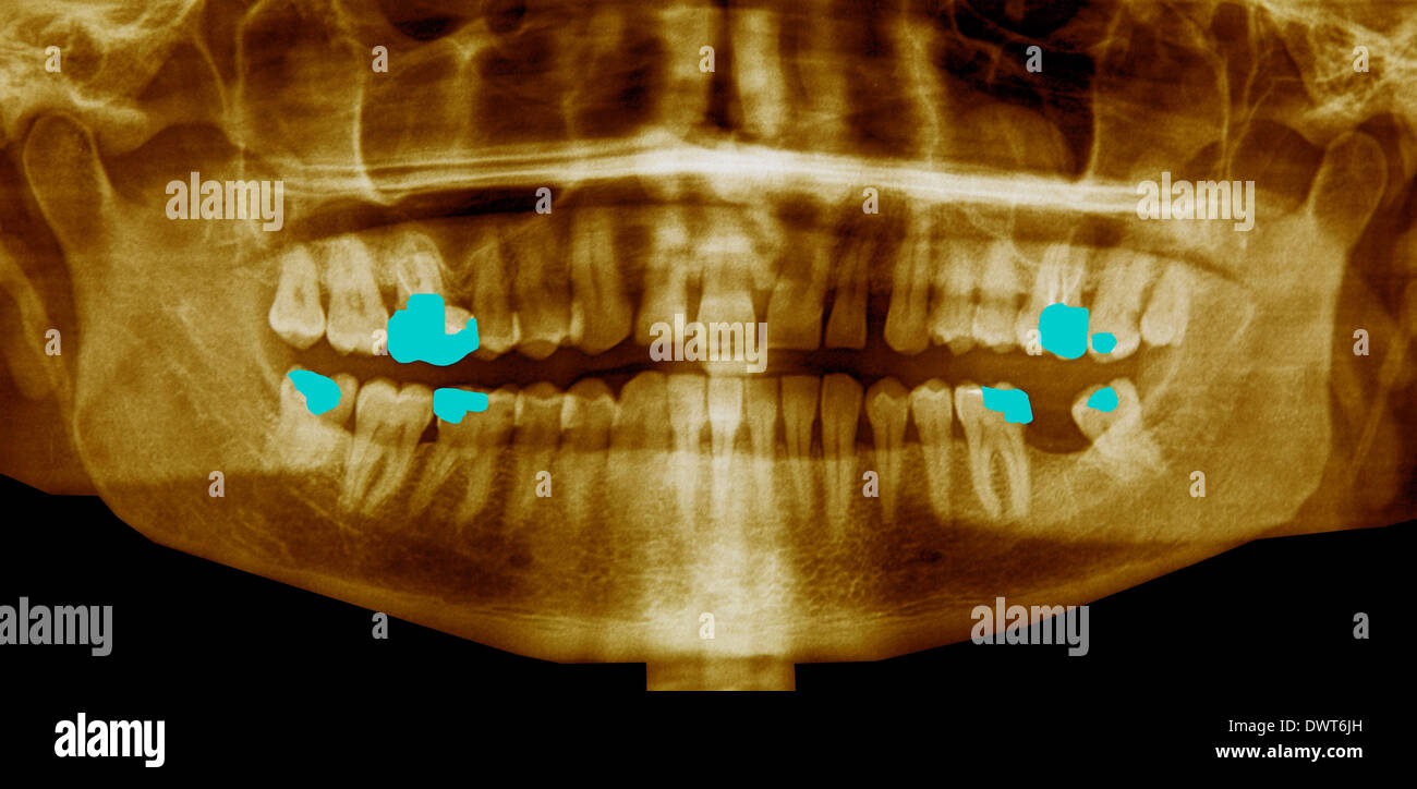 Dental x ray amalgam hi-res stock photography and images - Alamy