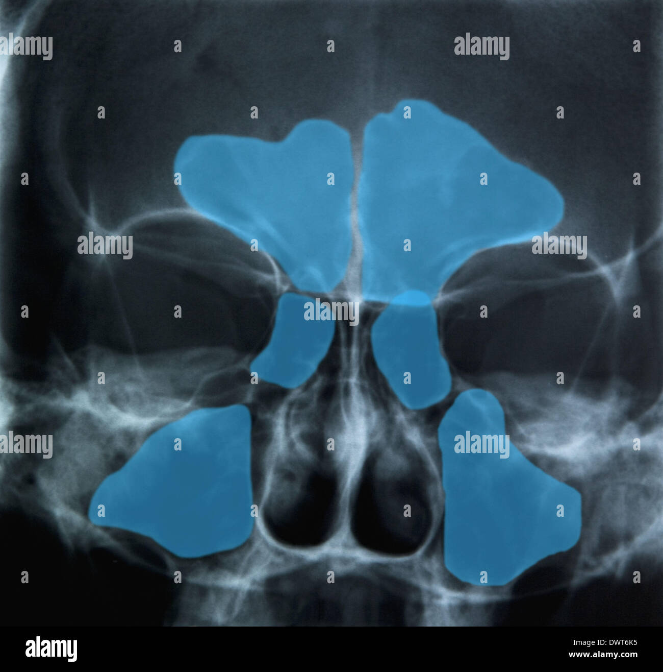 Sinus x ray Stock Photo - Alamy