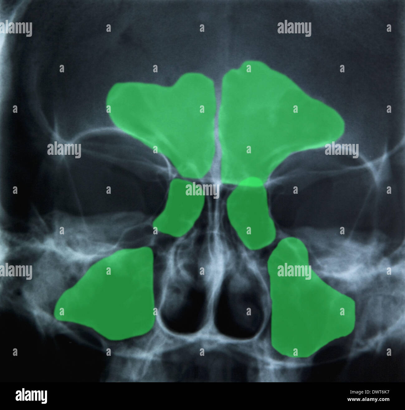 Sphenoid Sinus Stock Photos & Sphenoid Sinus Stock Images - Alamy
