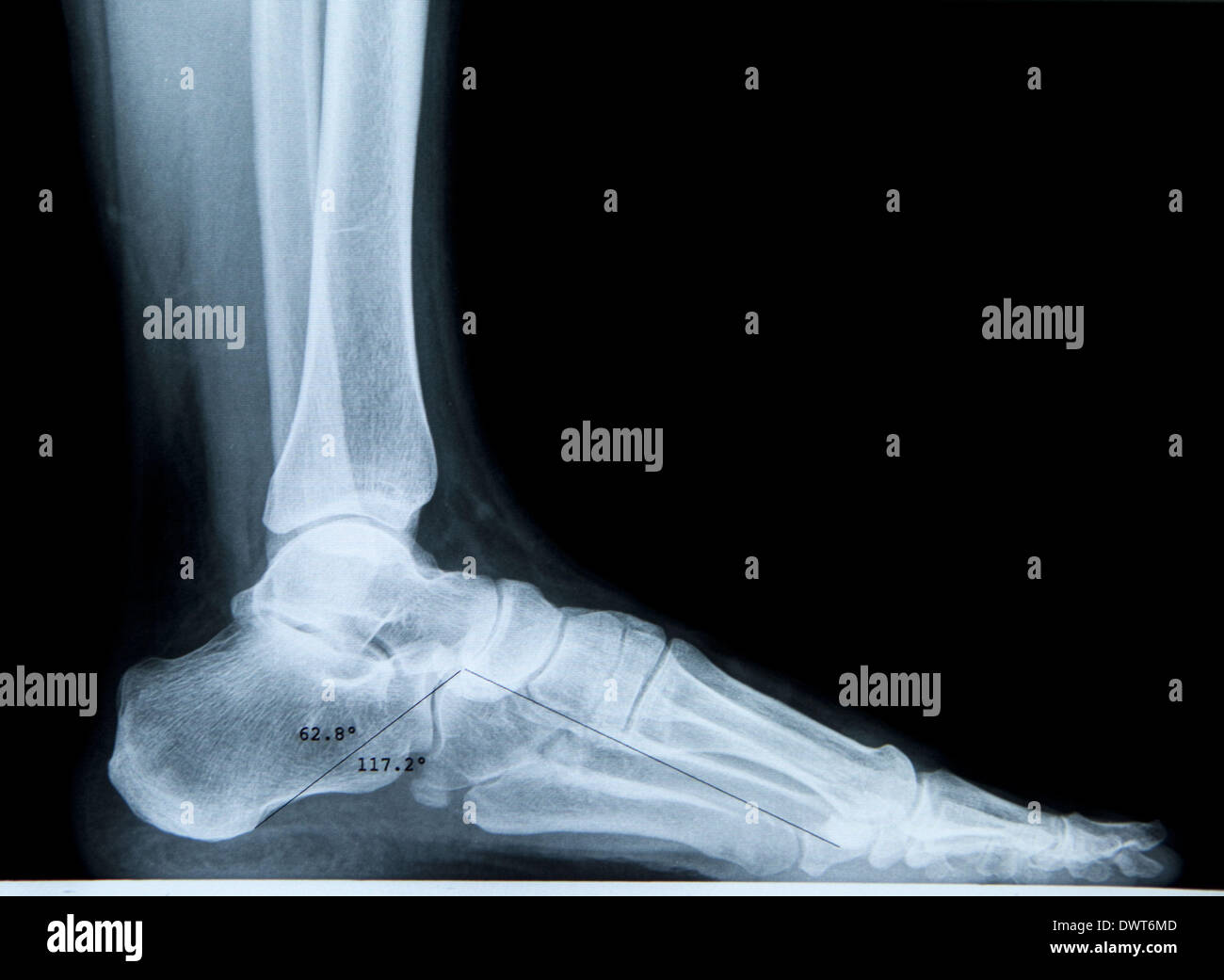 Foot x ray Stock Photo - Alamy