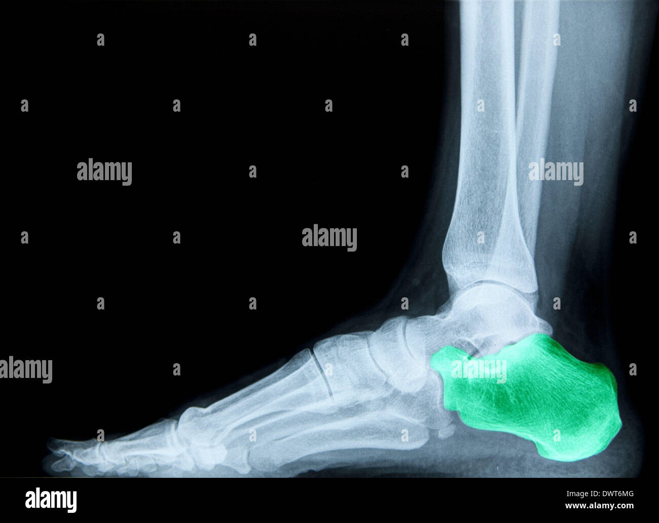 Foot x ray Stock Photo - Alamy