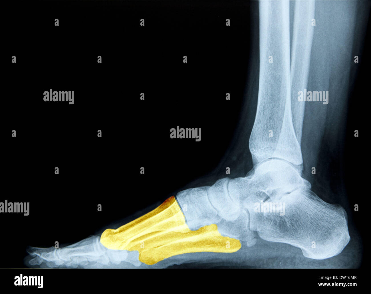Foot x ray Stock Photo - Alamy