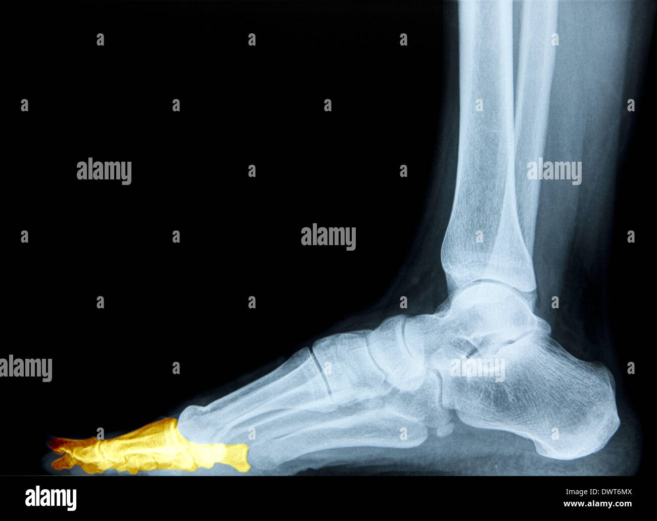 Foot x ray Stock Photo - Alamy