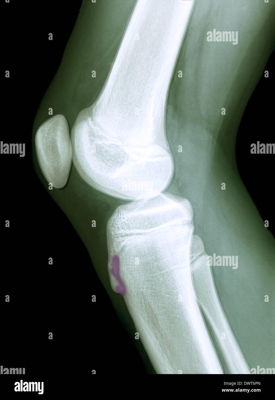 Osgood Schlatter Disease