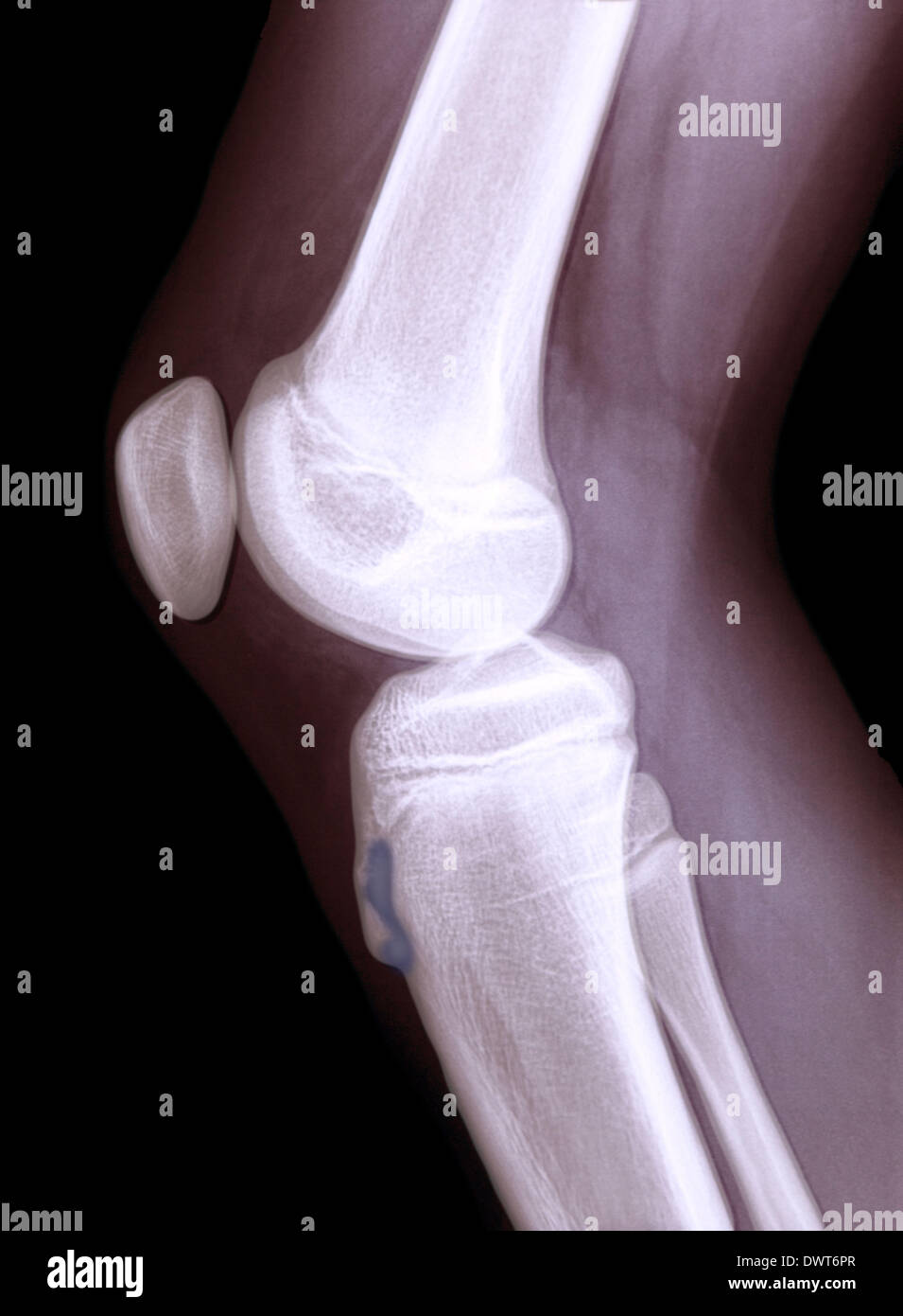 Osgood schlatter disease hi-res stock photography and images - Alamy