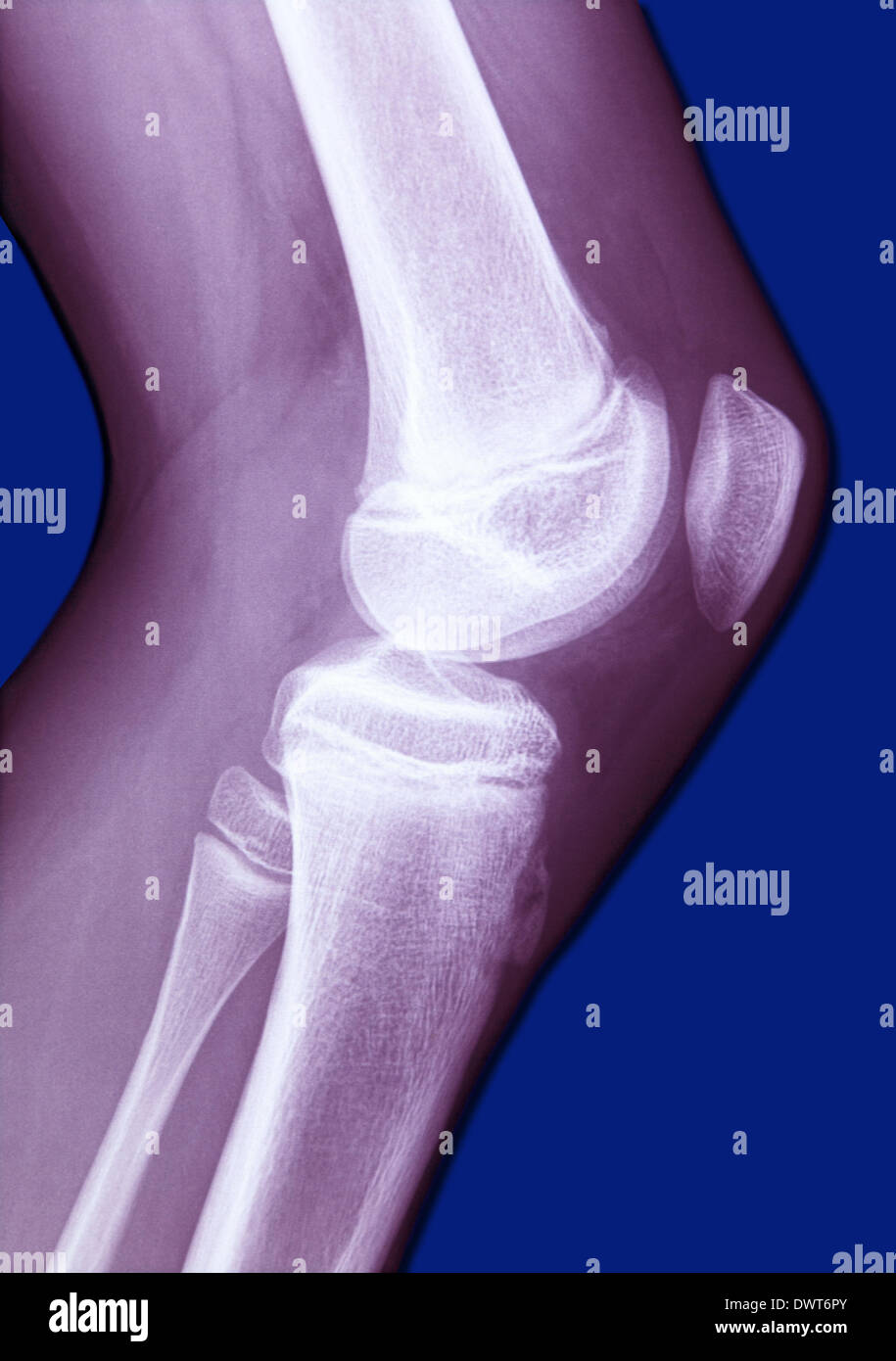 Child knee x ray hi-res stock photography and images - Alamy