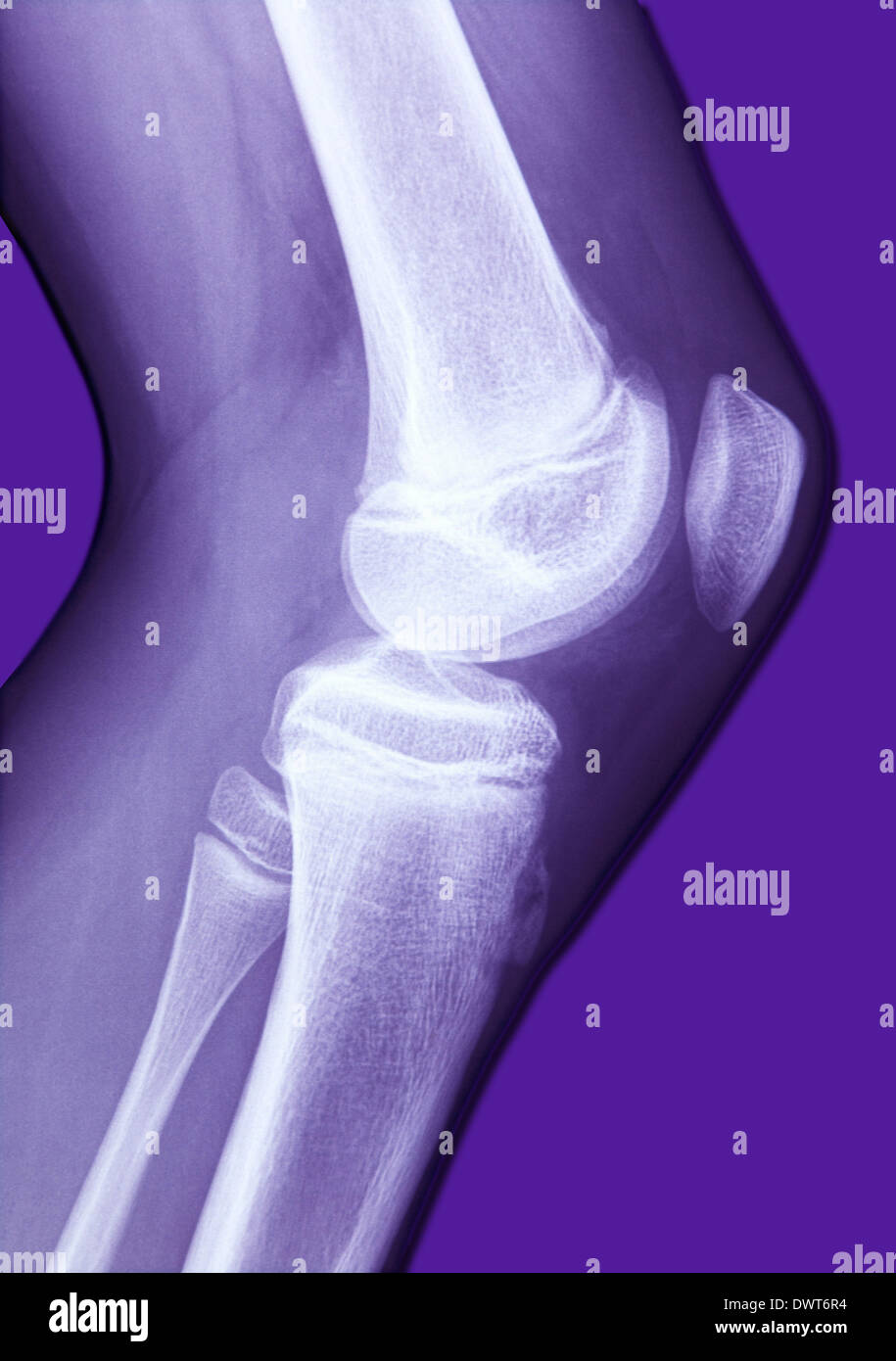 Knee x ray Stock Photo - Alamy