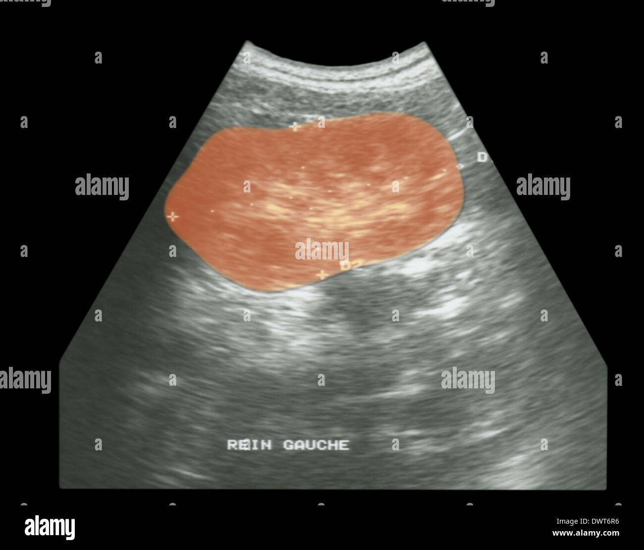 Kidney ultrasound scan Stock Photo - Alamy