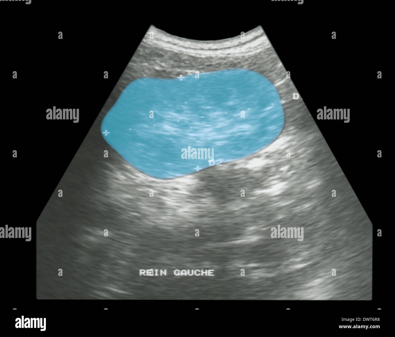 Kidney ultrasound scan Stock Photo - Alamy