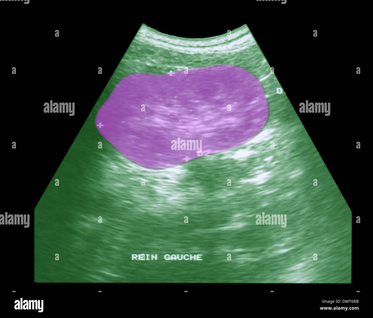 Kidney ultrasound scan Stock Photo - Alamy