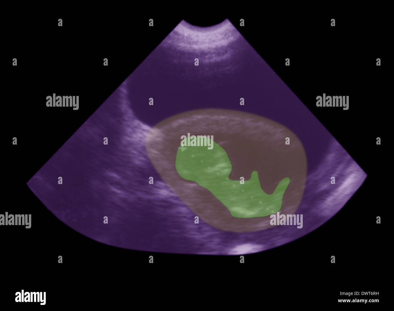 Fetus ultrasound scan Stock Photo - Alamy