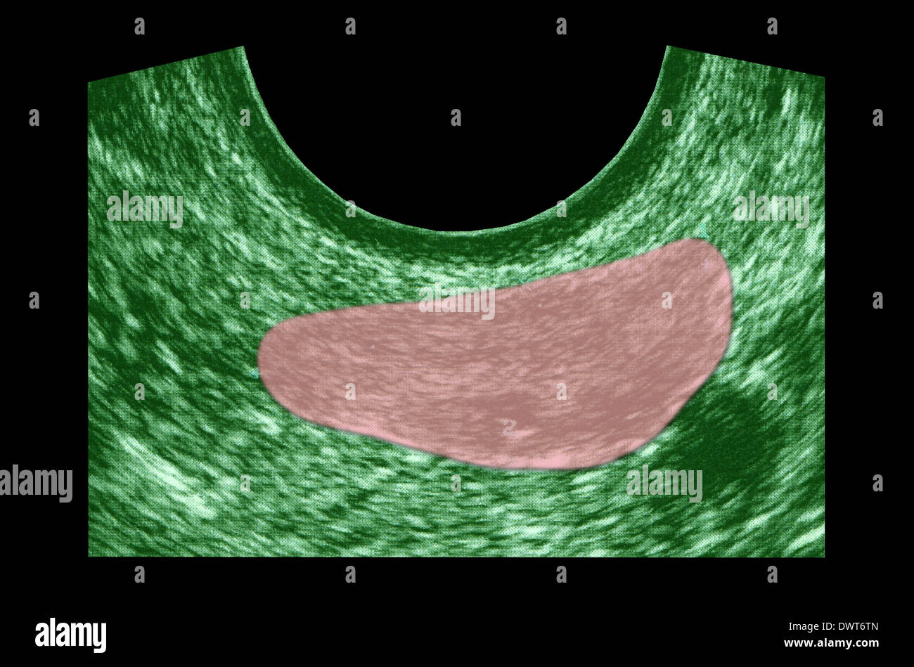 Uterine lace hi-res stock photography and images - Alamy