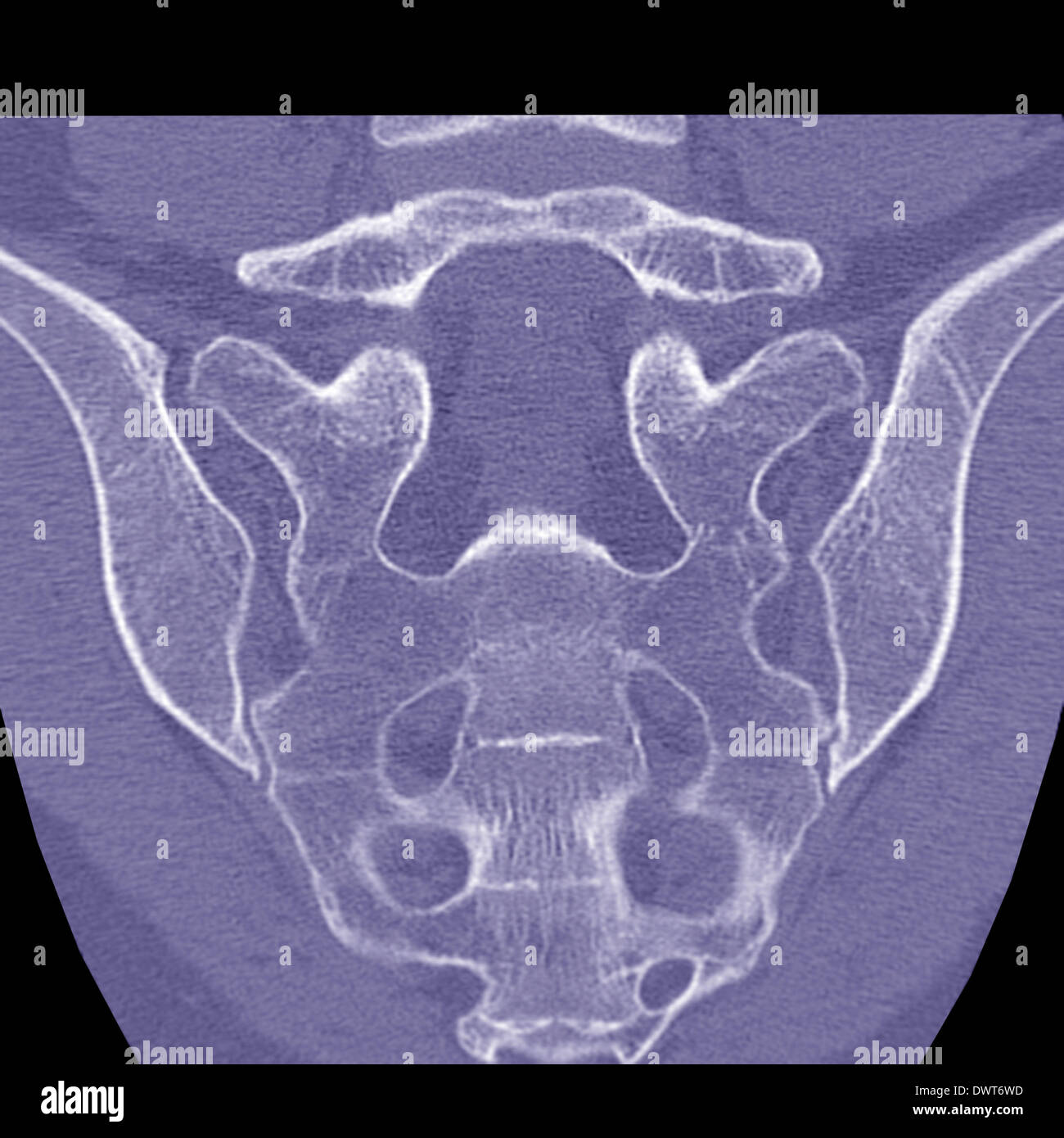 Scanner sacroiliac joint Stock Photo - Alamy