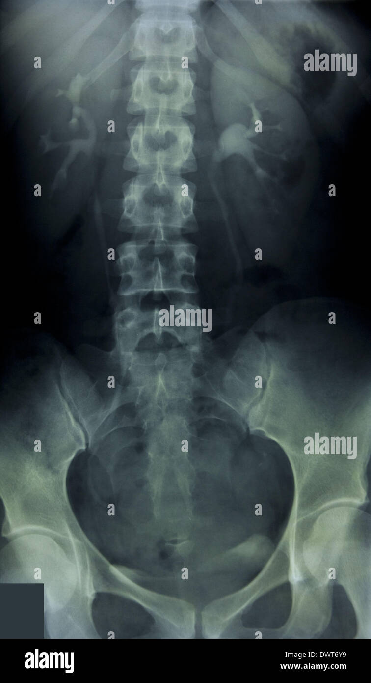 Urinary system x ray Stock Photo - Alamy