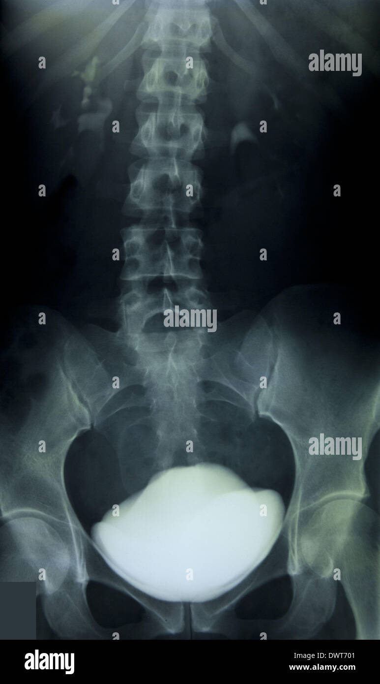 Urinary system x ray Stock Photo - Alamy