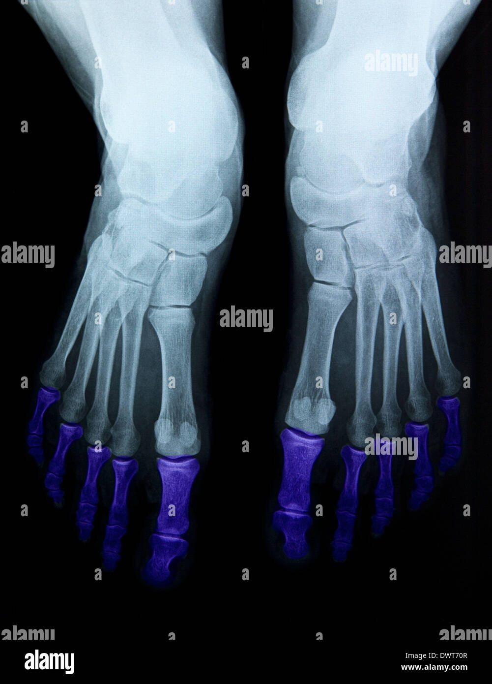 Foot x ray Stock Photo - Alamy