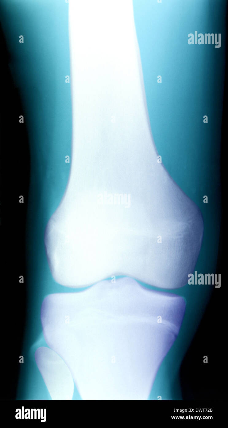 Child knee x ray hi-res stock photography and images - Alamy