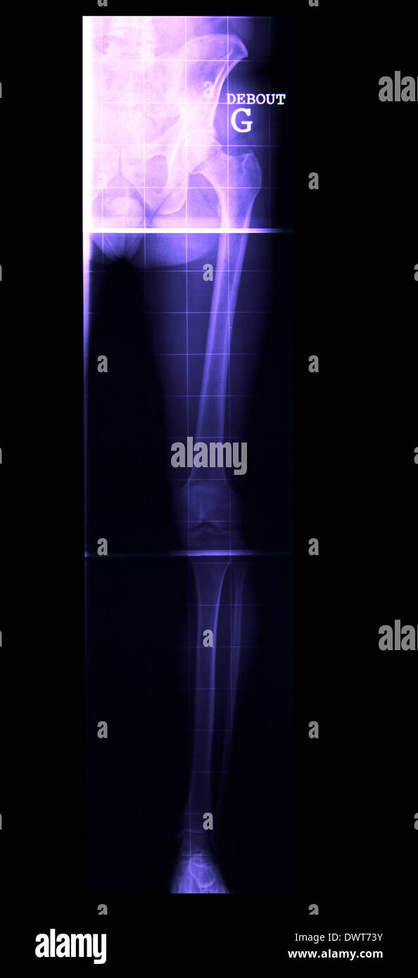 Leg x ray Stock Photo - Alamy