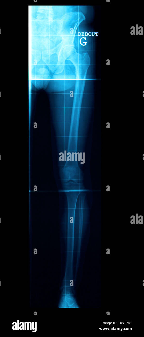 Leg x ray Stock Photo - Alamy