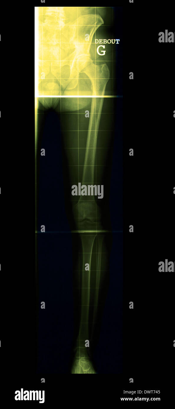 Leg x ray Stock Photo - Alamy