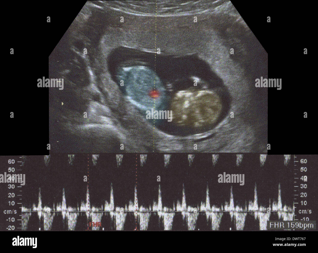 Fetus ultrasound scan Stock Photo - Alamy