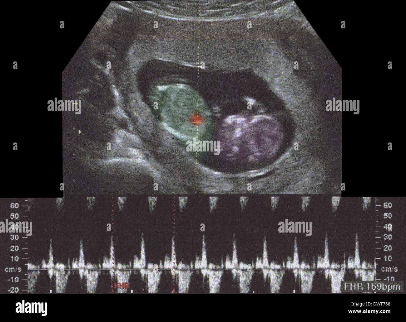 Fetal heart ultrasound hi-res stock photography and images - Alamy