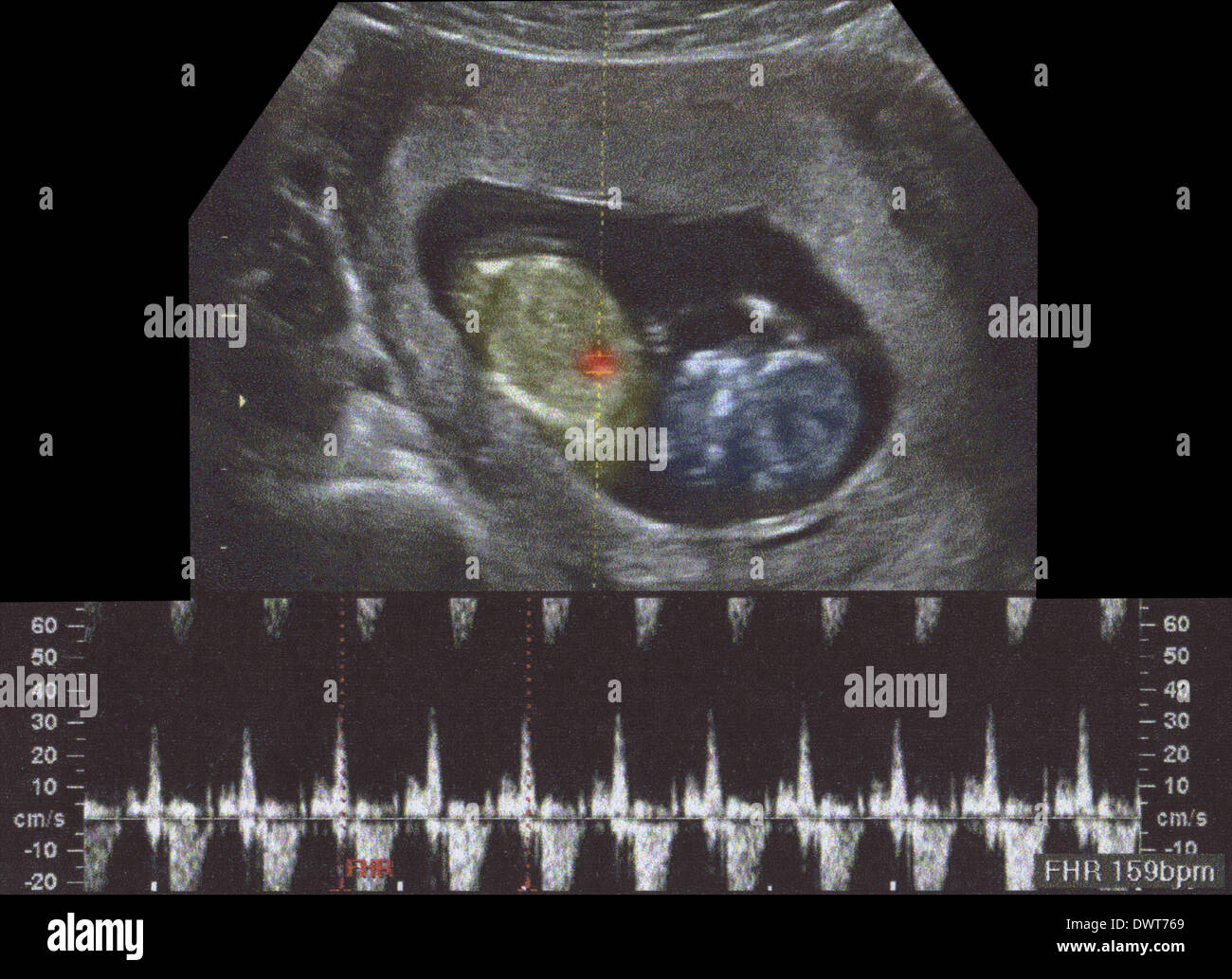 Fetal heart ultrasound hi-res stock photography and images - Alamy