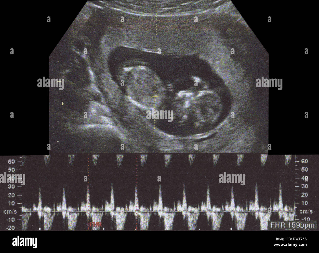 Fetus ultrasound scan Stock Photo - Alamy