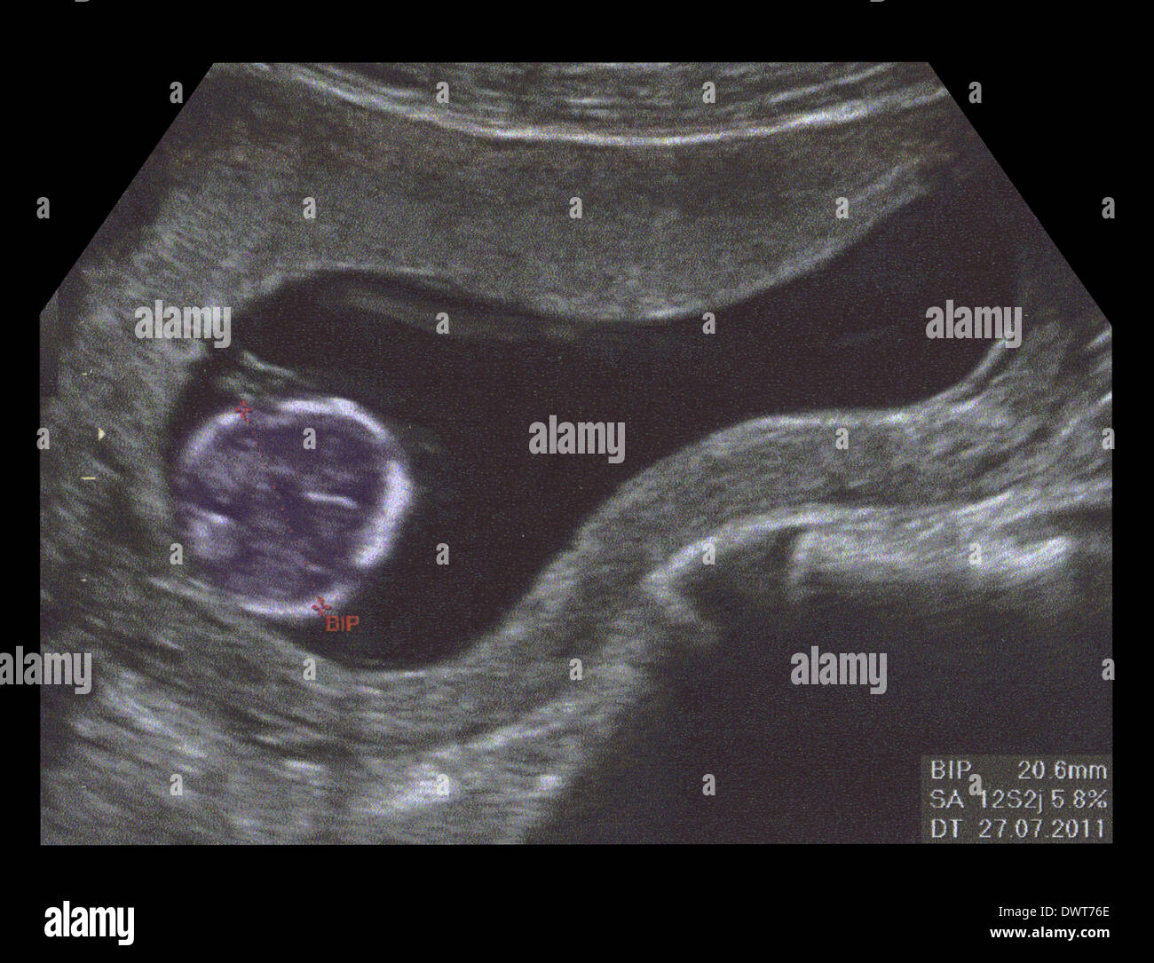 Fetus ultrasound scan Stock Photo - Alamy