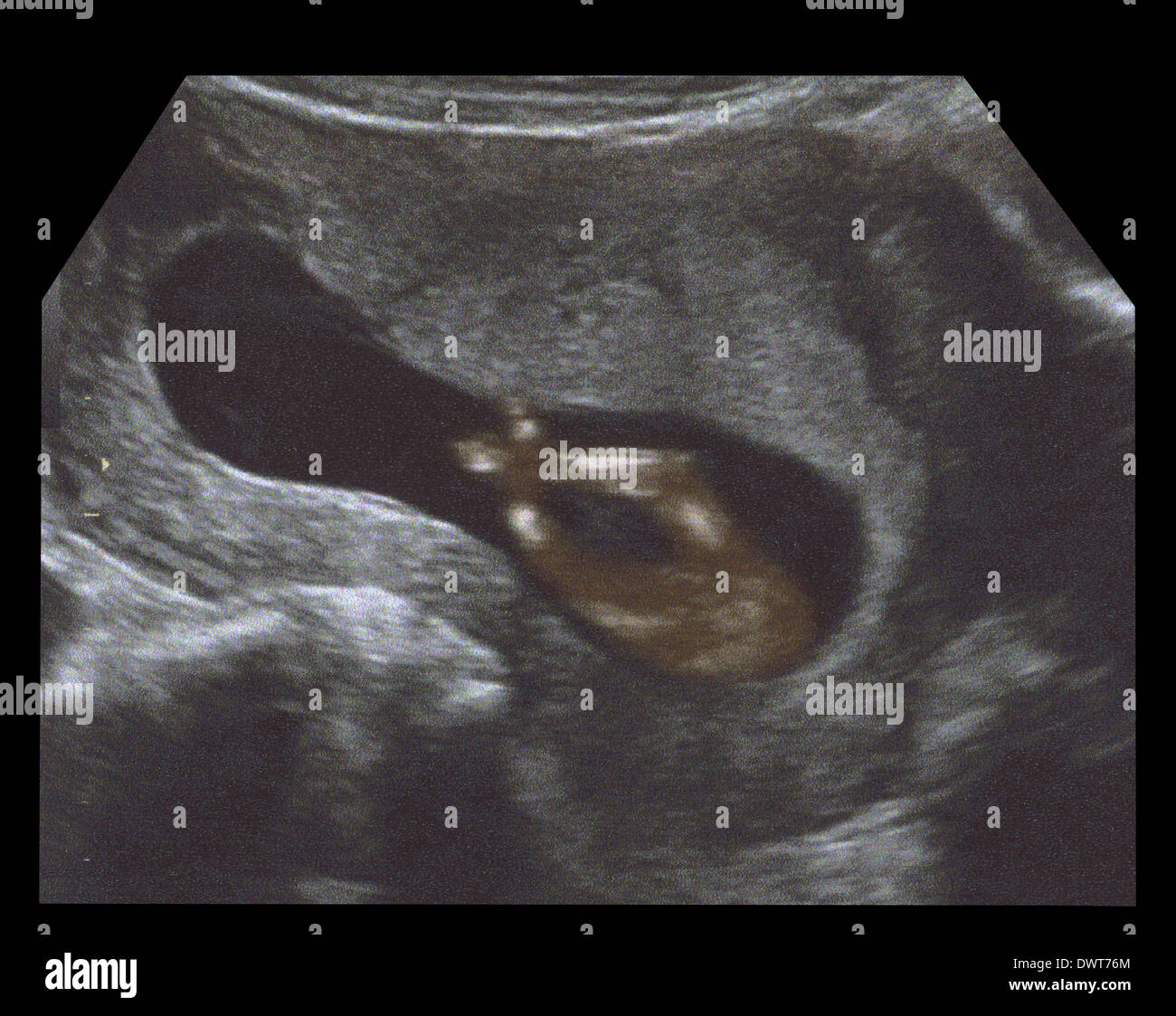 Fetus ultrasound first trimester hi-res stock photography and images ...
