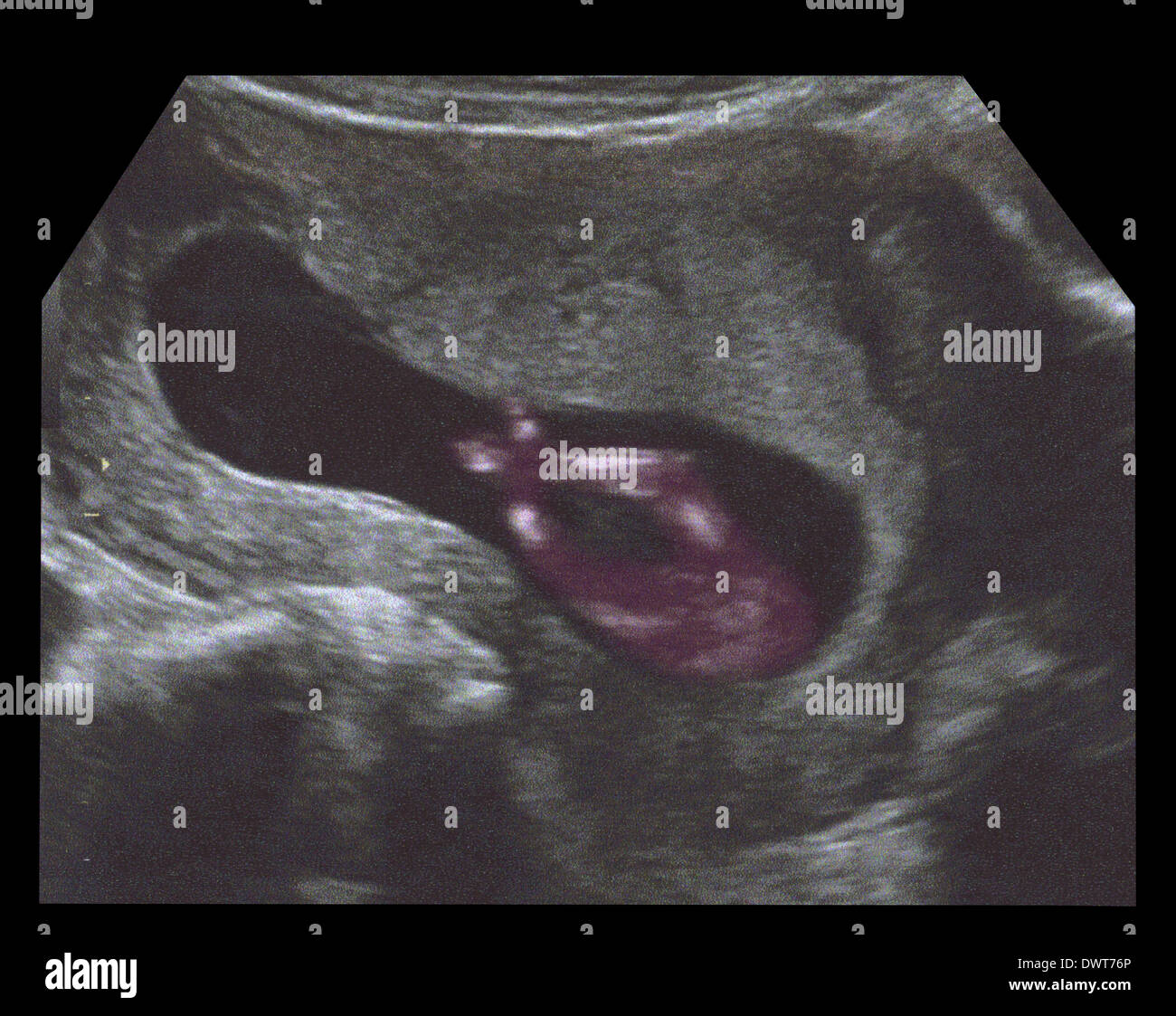 Obstetrical ultrasound hi-res stock photography and images - Alamy