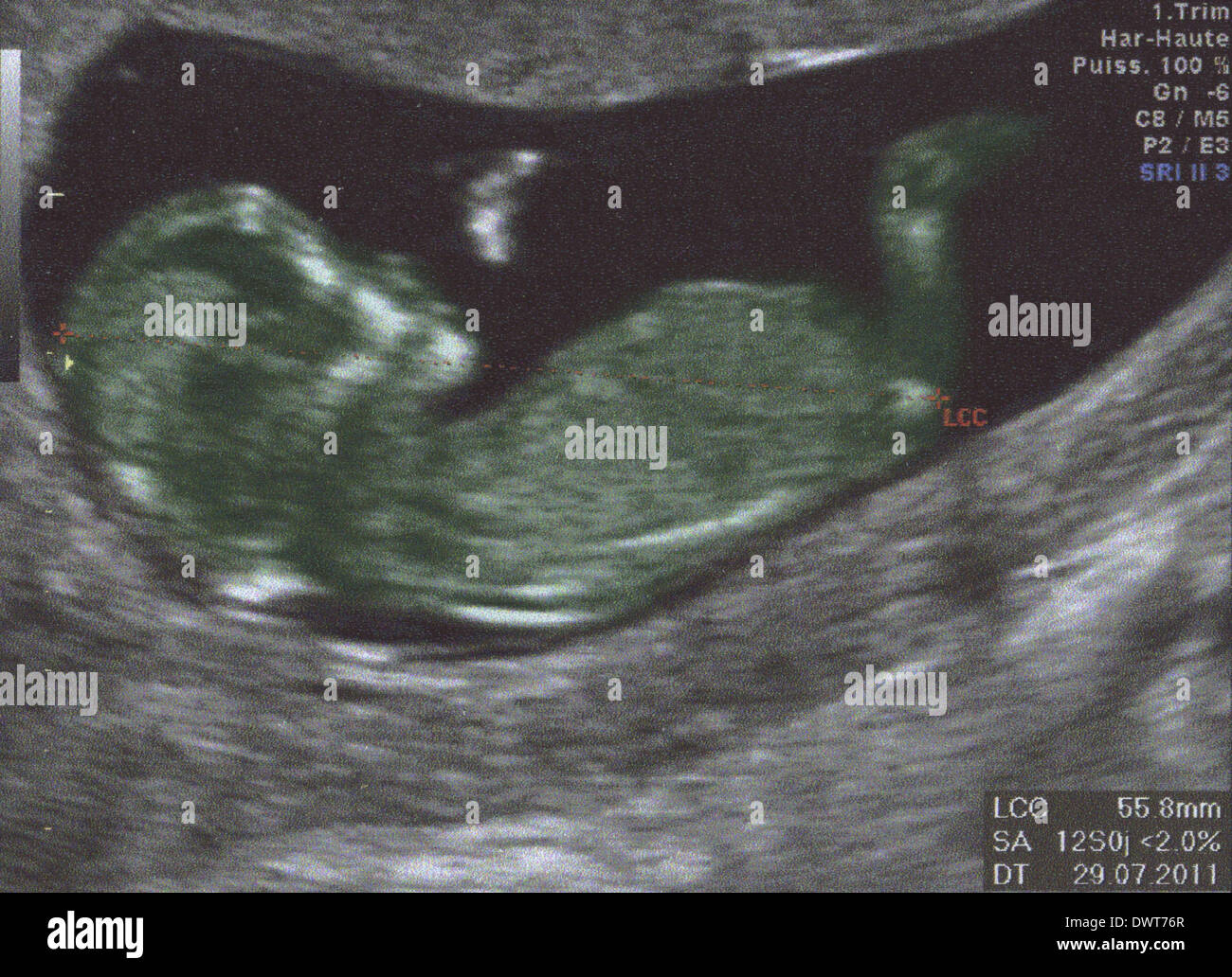 Fetus ultrasound first trimester hi-res stock photography and images ...