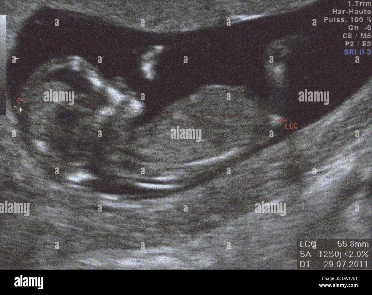 Obstetrical ultrasound hi-res stock photography and images - Alamy