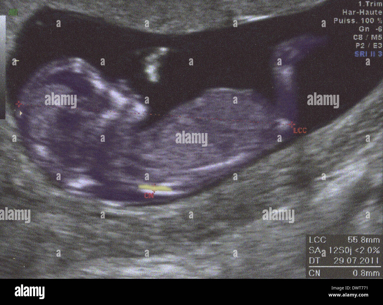 First trimester pregnancy screening hi-res stock photography and images ...