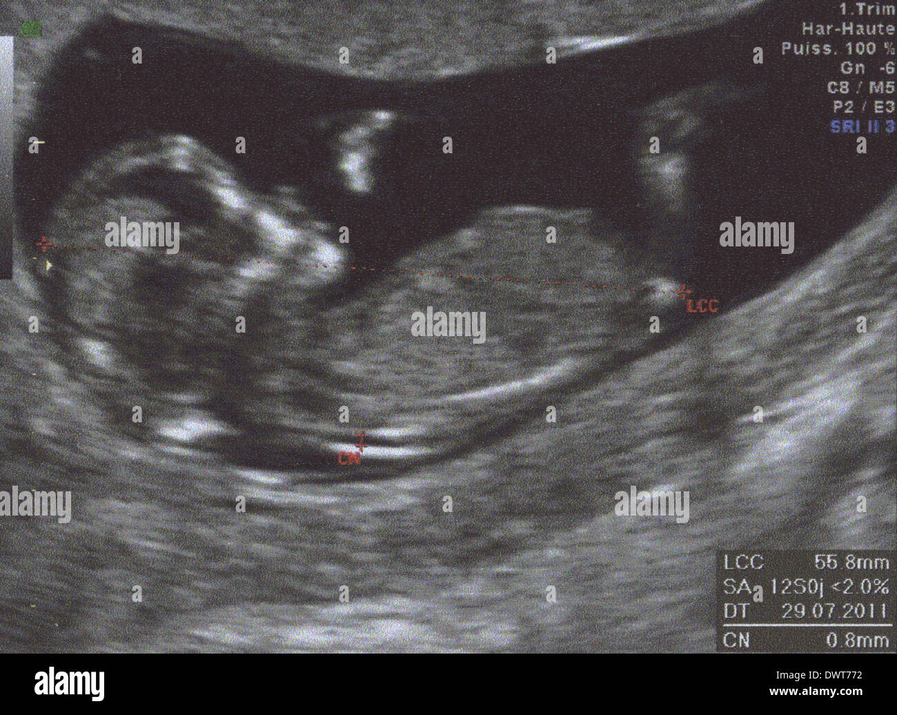 Fetus ultrasound scan Stock Photo - Alamy