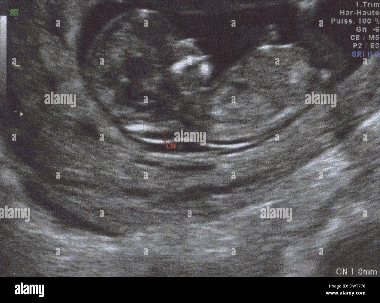 Fetus ultrasound scan Stock Photo - Alamy