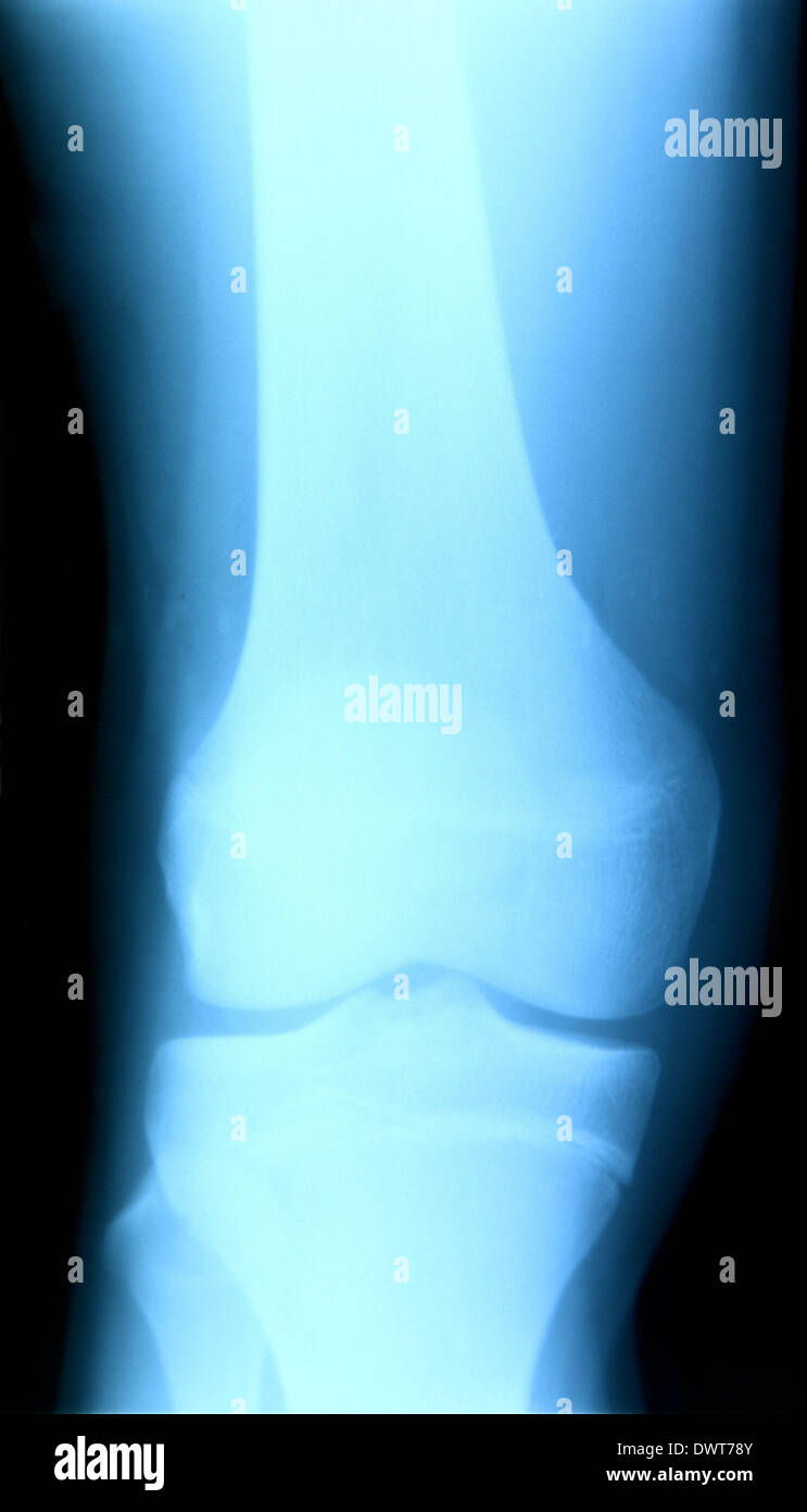 Child knee x ray hi-res stock photography and images - Alamy