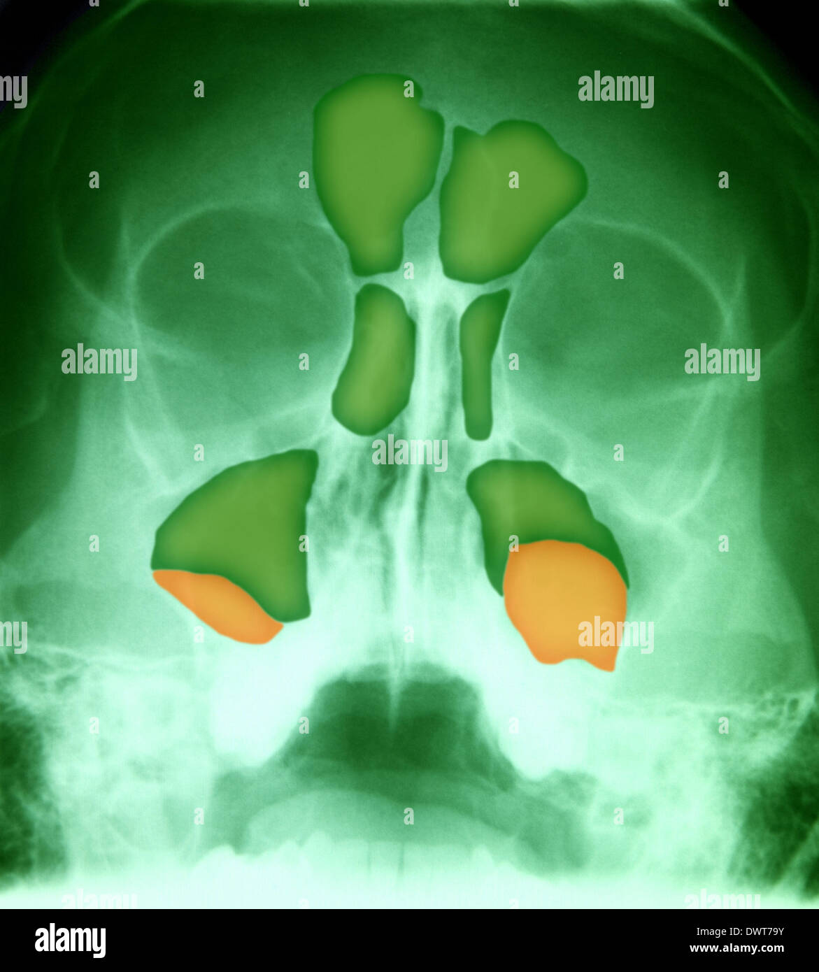 Sinus x ray Stock Photo - Alamy