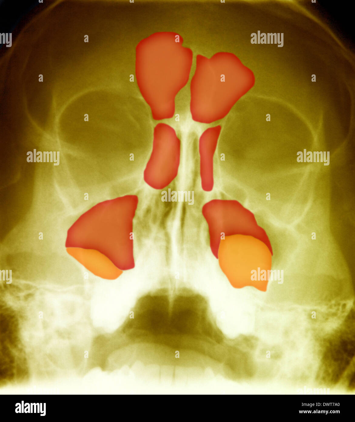Sinus x ray Stock Photo - Alamy