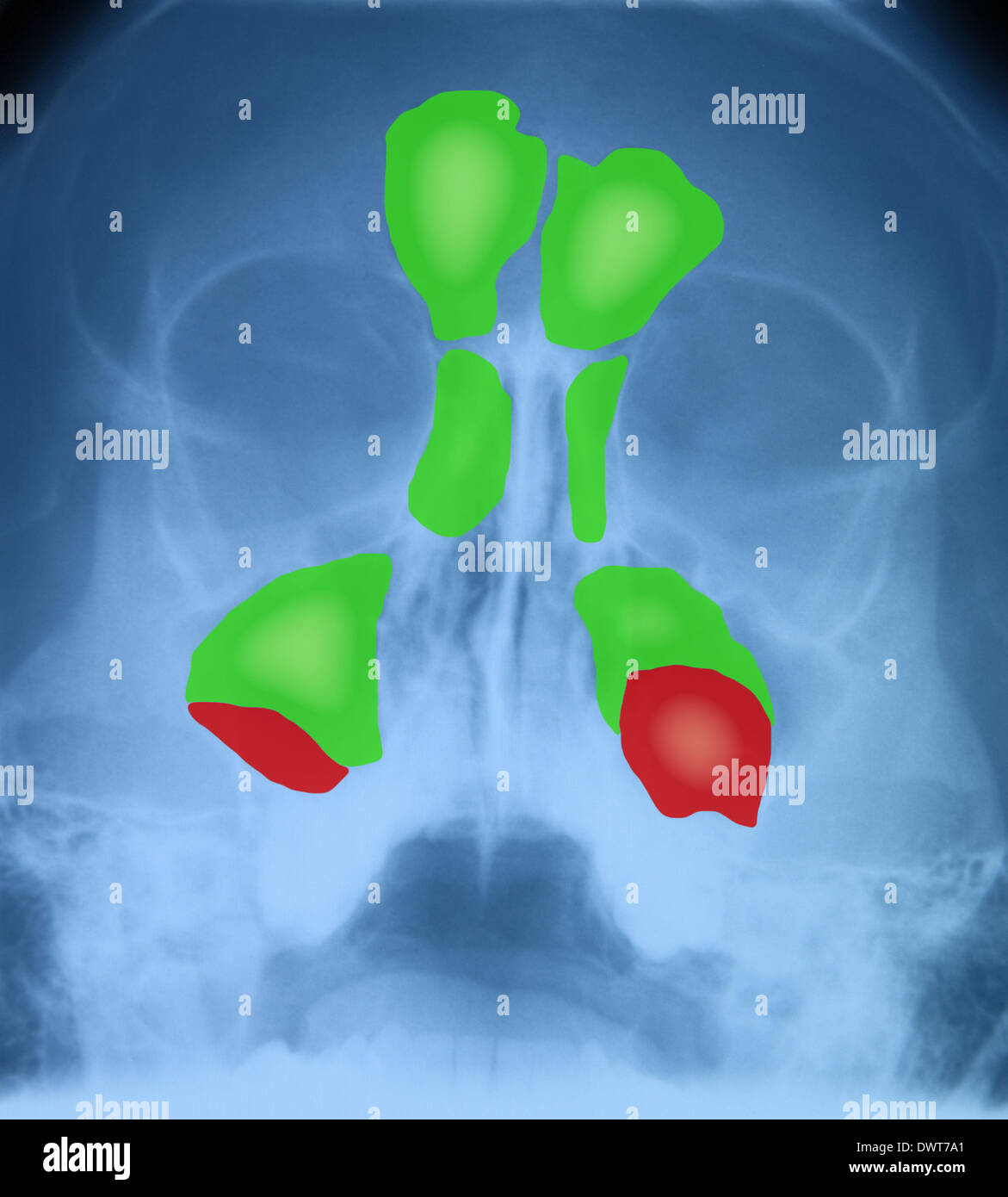 Abnormal Sinus X Ray