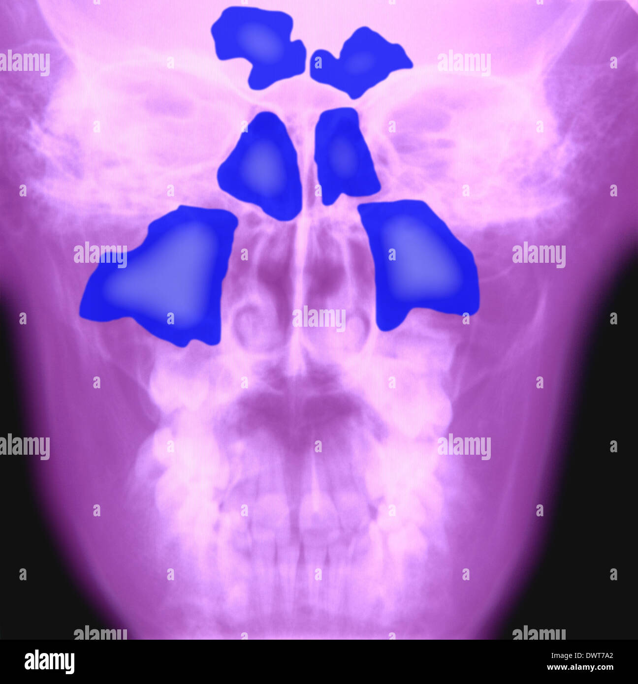 Sinus x ray Stock Photo - Alamy