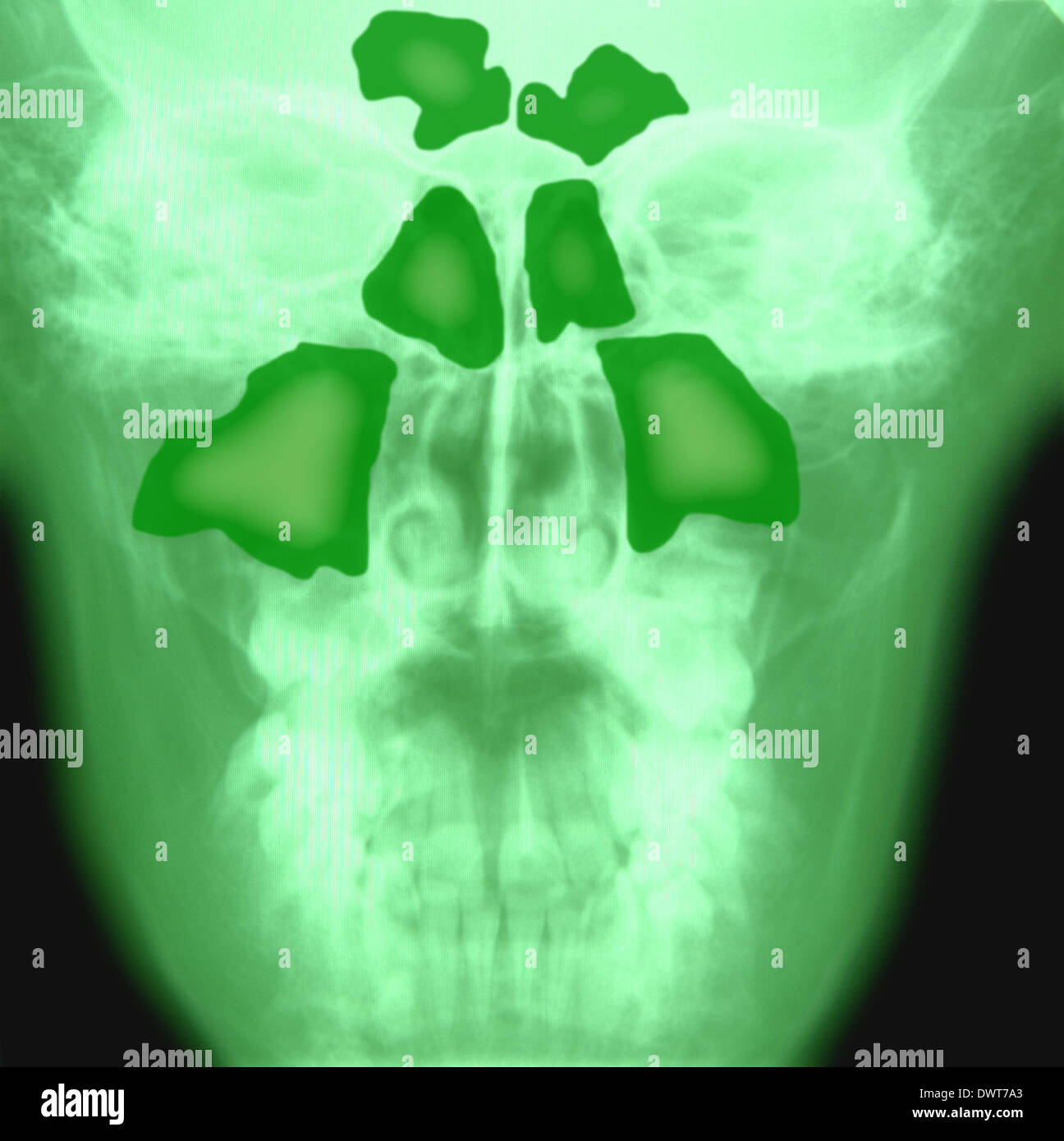 Sphenoid Sinus Stock Photos & Sphenoid Sinus Stock Images - Alamy