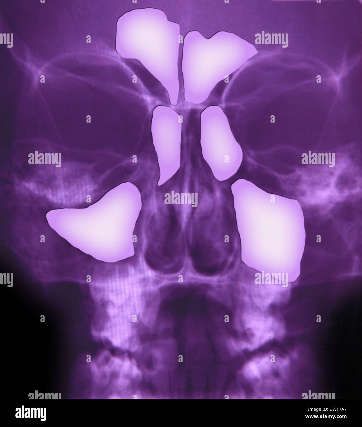 Sinus x ray Stock Photo - Alamy