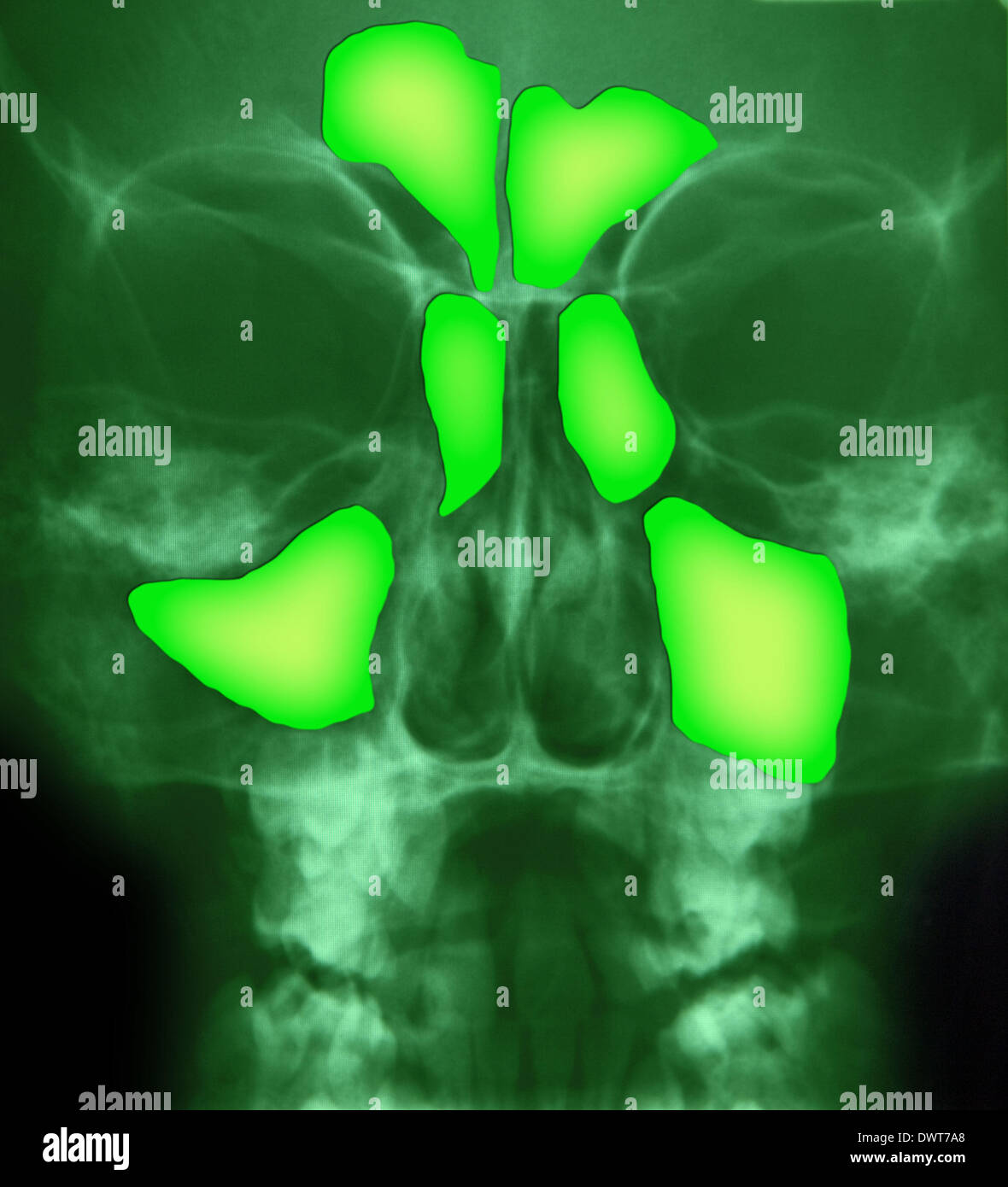Maxillary paranasal hi-res stock photography and images - Alamy