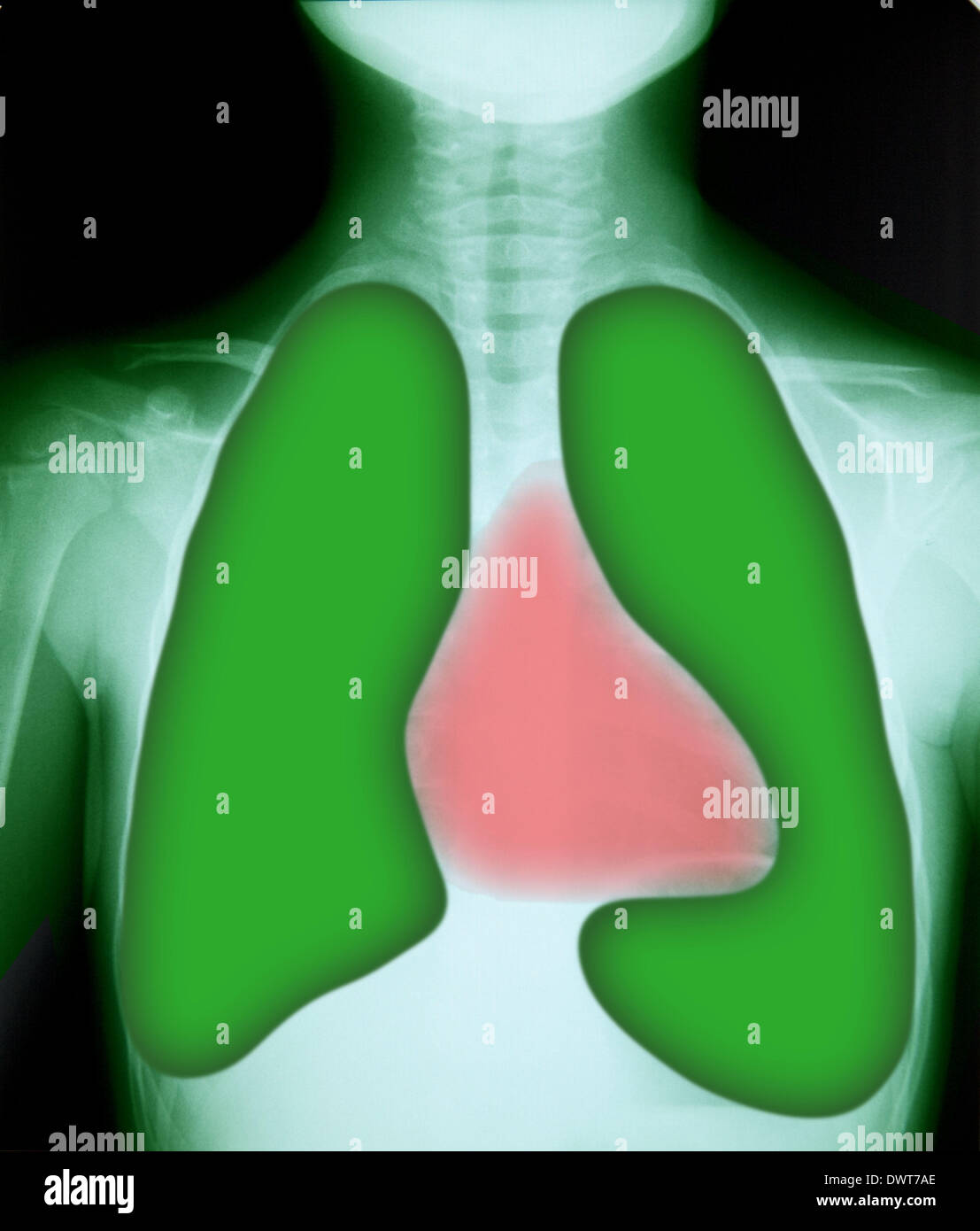Thorax x ray Stock Photo - Alamy